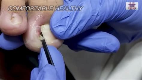 Ingrown Toenail And Impacted Toenail Relief And Prevention