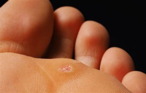 Diferencias Entre Verruga Plantar Y Verruga Sooluciona