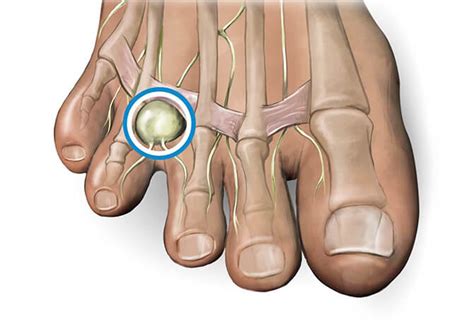 Mortons Neuroma Clear Information About Mortons Neuroma Surgery