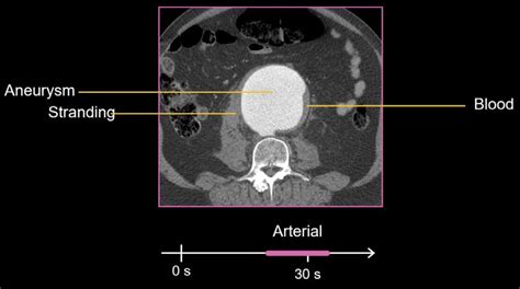 Abdominal CT Phases LITFL Radiology Library