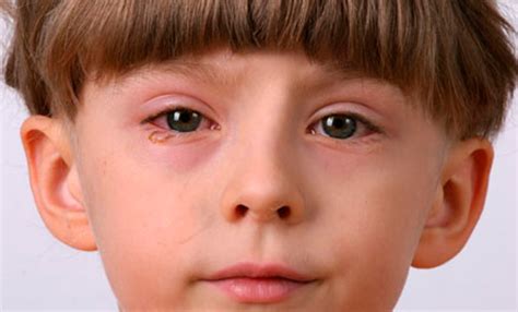 Conjuntivitis cómo prevenirla y cómo tratarla
