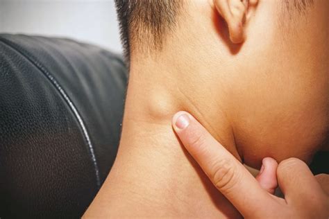 تورم غدد لنفاوی چیست این بیماری چه علائمی دارد و چگونه درمان میشود