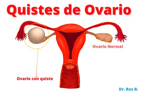Quistes de Ovario Diagnóstico y Tratamiento Dr Ros Berruezo