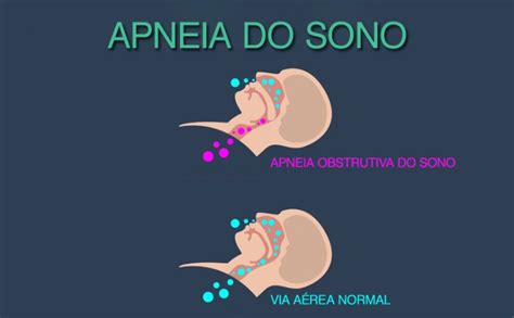APNÉIA DO SONO Piacezzi Cirurgia Oral