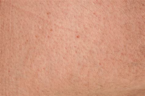 Keratosis On Arms