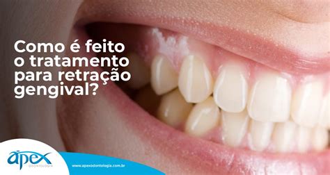 Como é feito o tratamento para retração gengival Ápex Odontologia