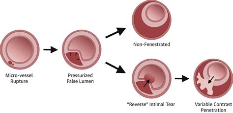 Spontaneous Coronary Artery Dissection Pathophysiological Insights