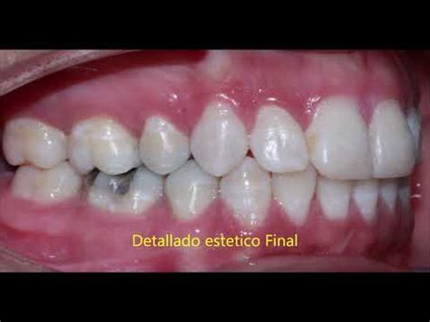 Caso Biprotrusión Dental YouTube