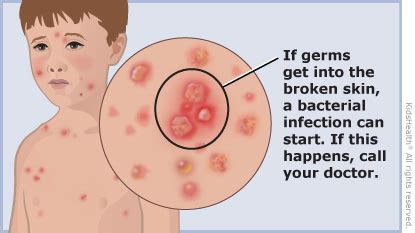 Chickenpox Varicella