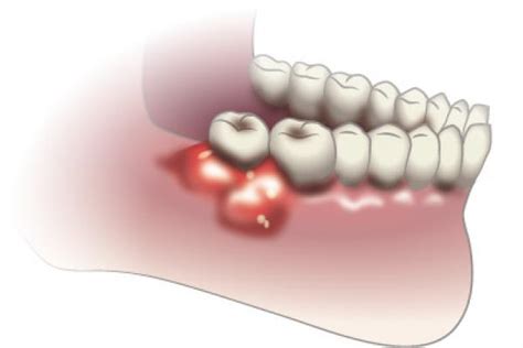 Comment soigner un abcès dentaire Dentiste à St Eustache