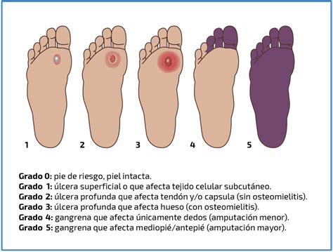 Pie diabético Dr Sánchez Quito
