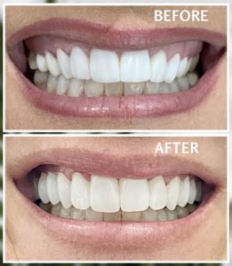 Before And After Dental Care Riverview Dental Arts