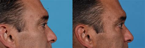 Before After Photo Gallery Sculpt Aesthetic Center