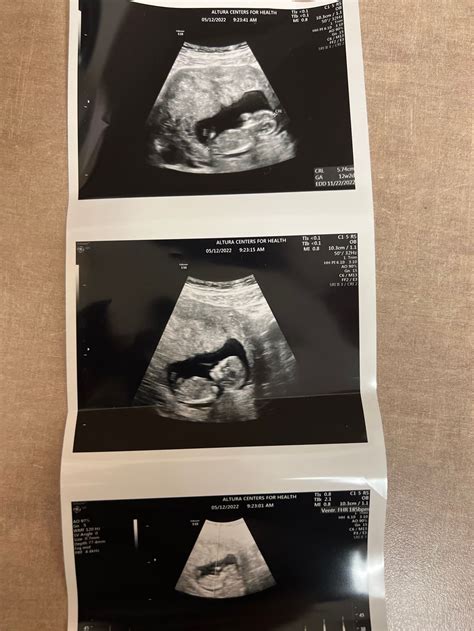 Weeks Days Ultrasound Any Gender Guesses Gender Prediction