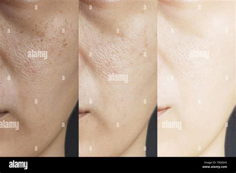 Cara de melasma fotografías e imágenes de alta resolución Alamy