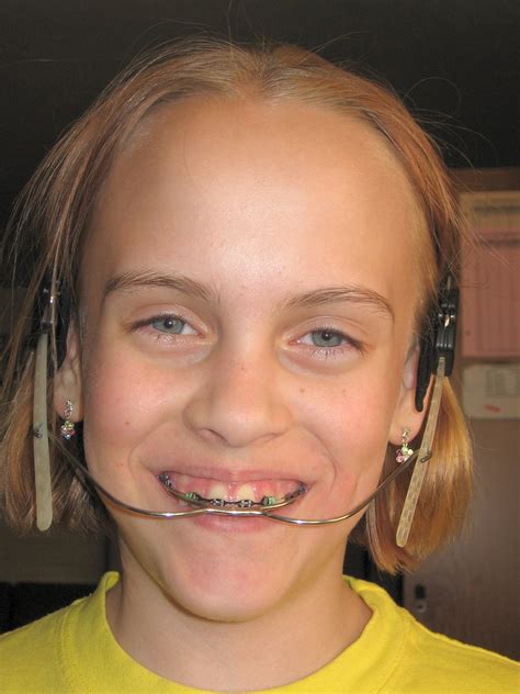 Untitled Braces Headgear Flickr