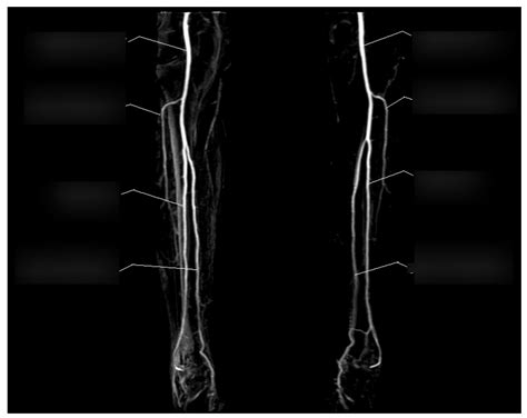 Lower Leg Arteries Diagram Quizlet