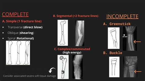 Approach To Describing Fractures On X Ray YouTube