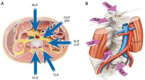 Lumbar Interbody Fusion Techniques Indications And Comparison Of