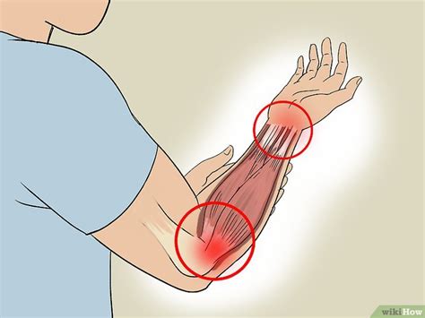 11 Formas De Curar Un Dolor En El Antebrazo WikiHow