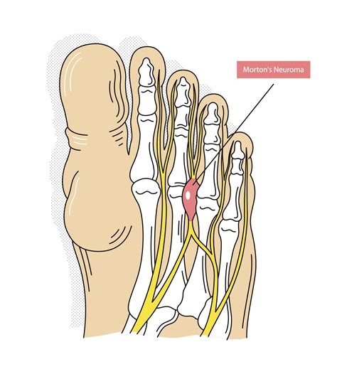 Morton S Neuroma Treatment Symptoms Causes The Foot Hub