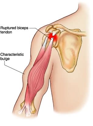 What Is A Biceps Tendon Rupture And How Is It Fixed