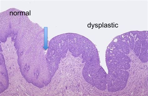 Pathology Neoplasia Part Flashcards Quizlet