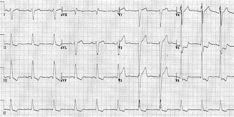 Biventricular Hypertrophy Litfl Ecg Library Diagnosis