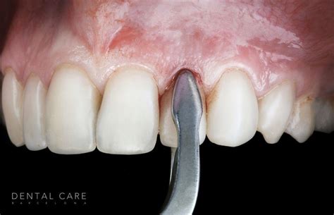 Consejos para tratar un flemon después de la extracción dental