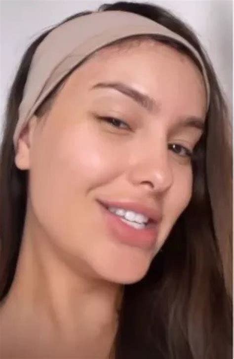 Ex Bbb Thais Braz Mostra A Cicatriz De Sua Pl Stica Na Testa Mh