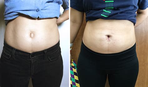 Umbilical Hernia Repair
