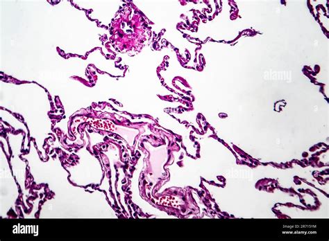 Histopathology Of Lung Emphysema Light Micrograph Photo Under
