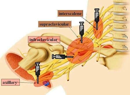 Brachial Plexus Block M C Used Methed Supraclavicular Block
