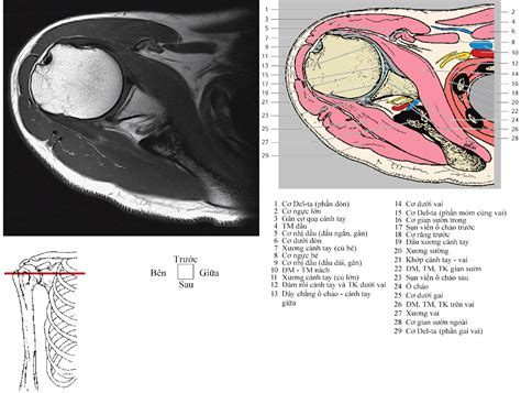 Giải Phẫu MRI Khớp Vai
