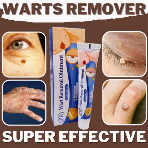 Warts Remover Original Cream Kasoy Cream Mole Warts Skin Tag Removal
