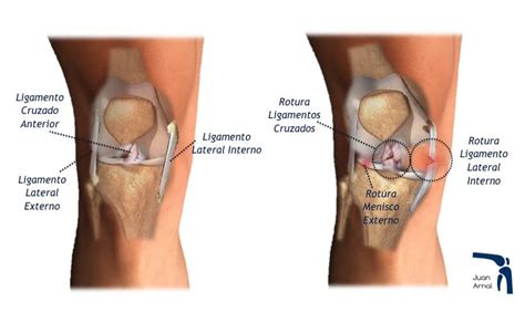 Rodilla Multi Ligamentosa Rotura Varios Ligamentos De La Rodilla