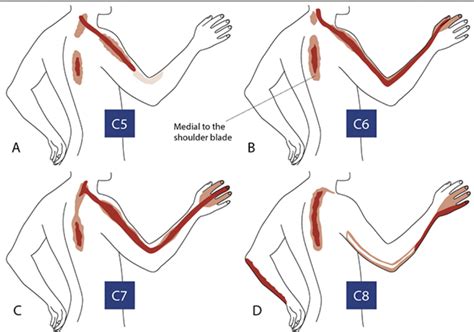 Cervical Radiculopathy Physical Therapy Pdf Mechelle Dempsey