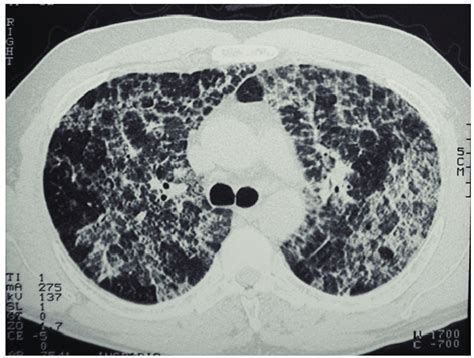 Chest HRCT At Diagnosis Showing The Typical Crazy Paving Pattern