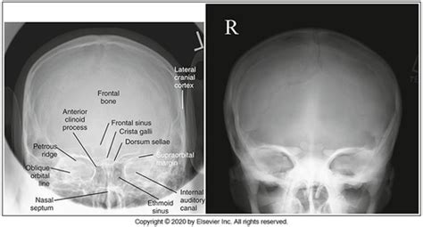 Chapter 11 Cranium Facial Bones Nasal Bones Paranasal Sinuses