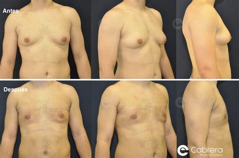Antes y después en ginecomastia Dr Emilio Cabrera