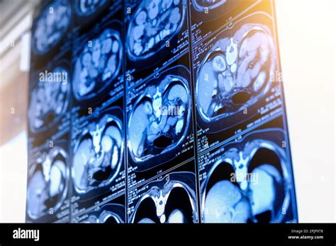 Computed Tomography CT Scan Of Chest With Abdomen Stock Photo Alamy