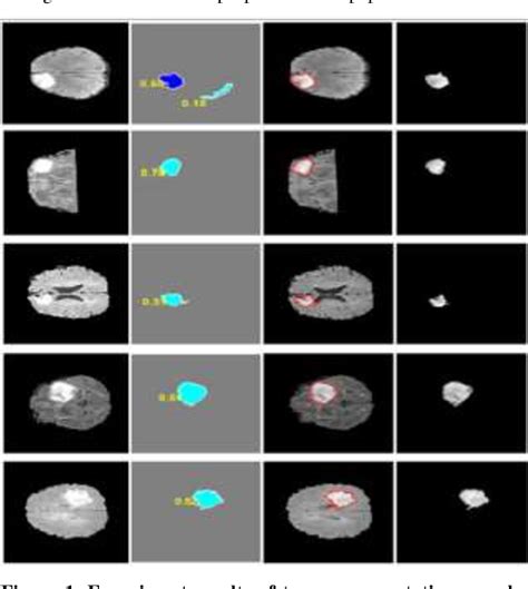 figure 1 from multiclass brain tumor classification using region growing based tumor
