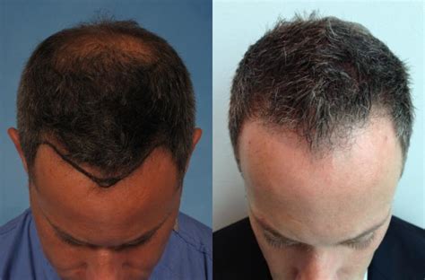 Fue Results Achieved With Smartgraft Or Neograft Before And After Photo