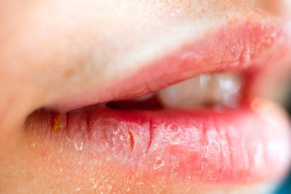 Chapped Lips Causes Treatments And Prevention