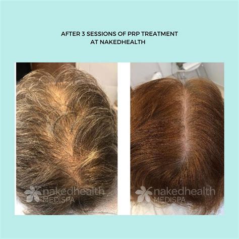 Prp For Hair Loss Nakedhealth Medispa Wimbledon