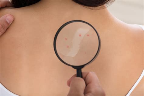 Démangeaison cutanée reconnaître des boutons d allergie