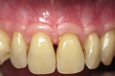 Gum Grafting Huntington Beach Cosmetic Periodontics Dr Braga
