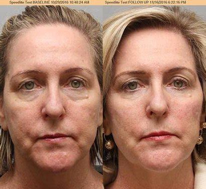 Rediscover Your Youthful Contours With Juvederm Voluma XC Lumier Medical