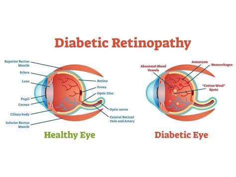 Retinopat A Diab Tica Causas S Ntomas Prevenci N Y Cura Remedios