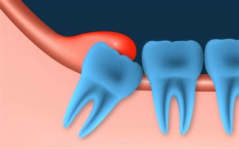 Pericoronaritis Tratamiento Y Causas Clinica Dental Palomero